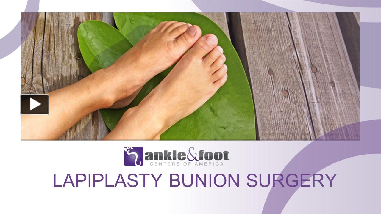 PPT – Lapiplasty Bunion Surgery PowerPoint presentation | free to ...