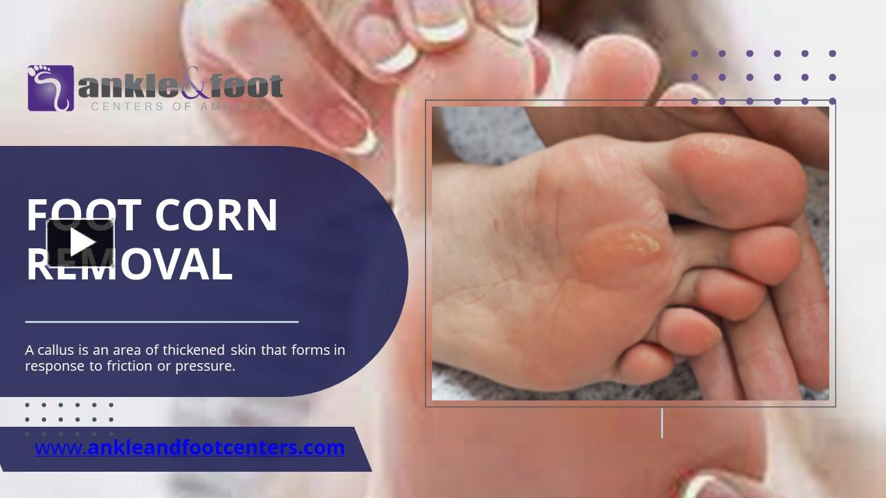 Foot Corn Removal | Ankle & Foot Centers of America presentation | free ...