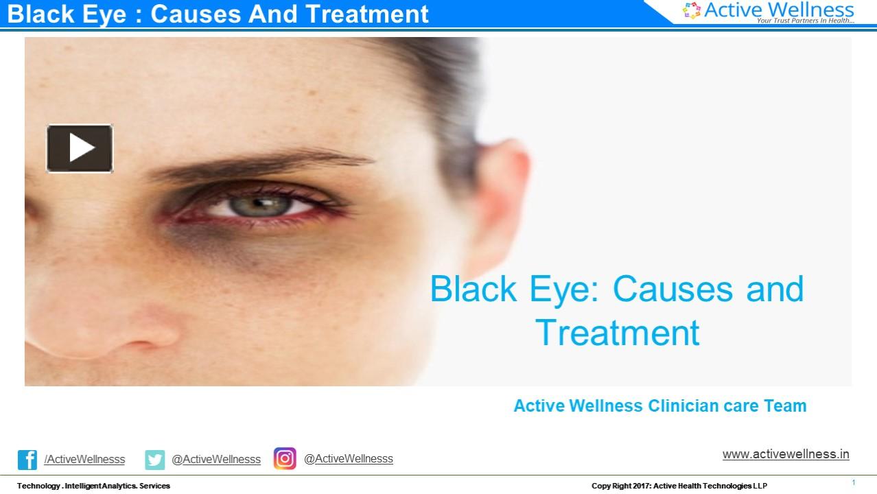 PPT – Black Eye : Causes And Treatment (1) PowerPoint presentation ...