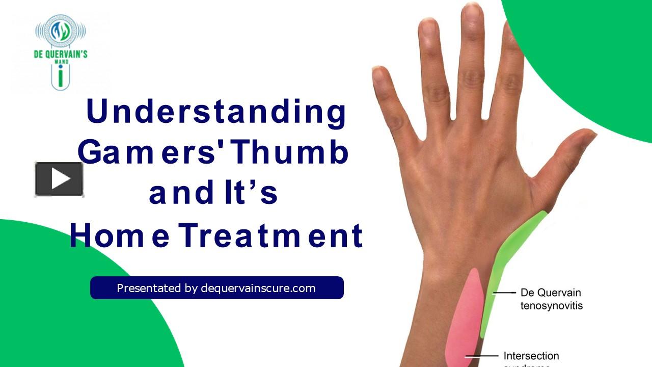 Unveiling Relief - Gamers' Thumb Home Treatment presentation | free to ...