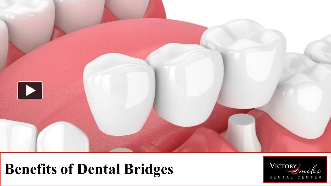 PPT – Transform Your Teeth with Dental Bridges - A Perfect Smile ...