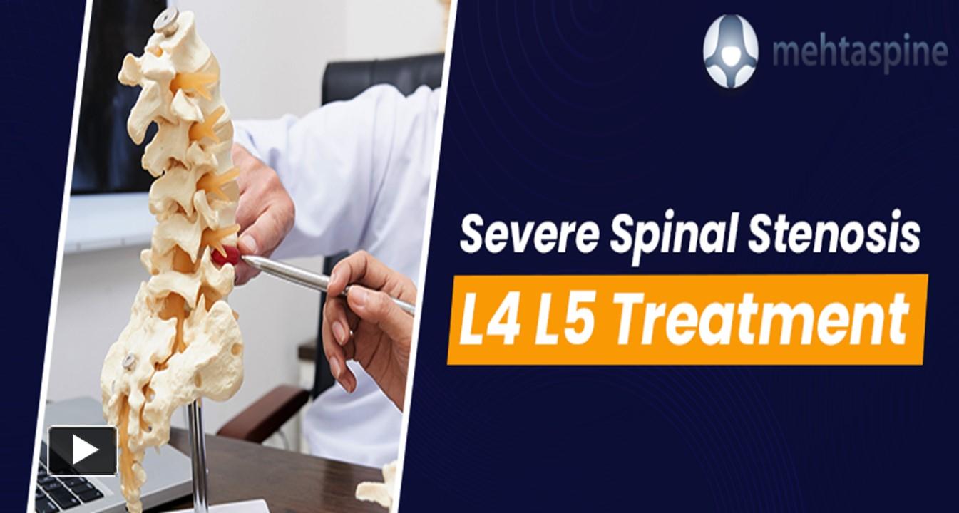 Effective L4-L5 Spinal Stenosis Treatment | Mehta Spine presentation ...