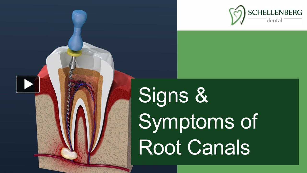 PPT – Unveiling the Truth About Root Canals: Signs & Symptoms ...