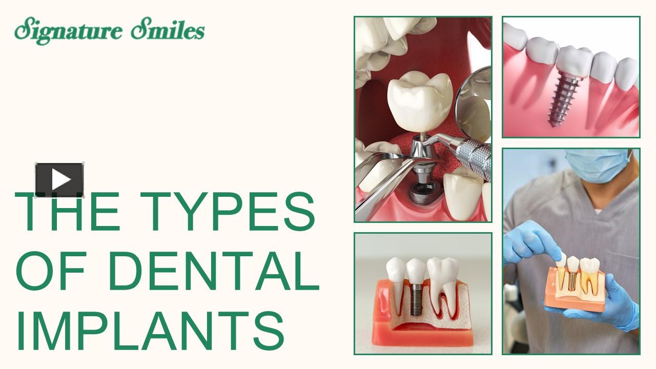 The Types of Dental Implants presentation | free to view