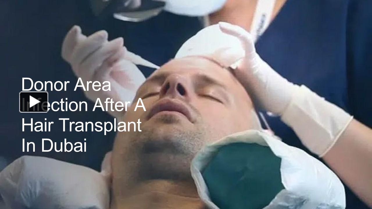 Donor Area Infection After A Hair Transplant In Dubai presentation ...