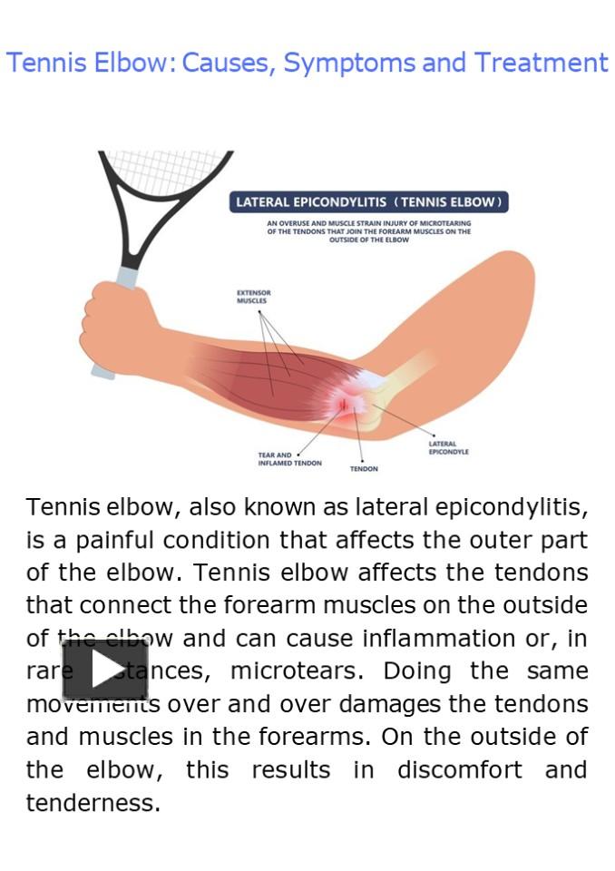 Tennis Elbow: Causes, Symptoms and Treatment presentation | free to ...