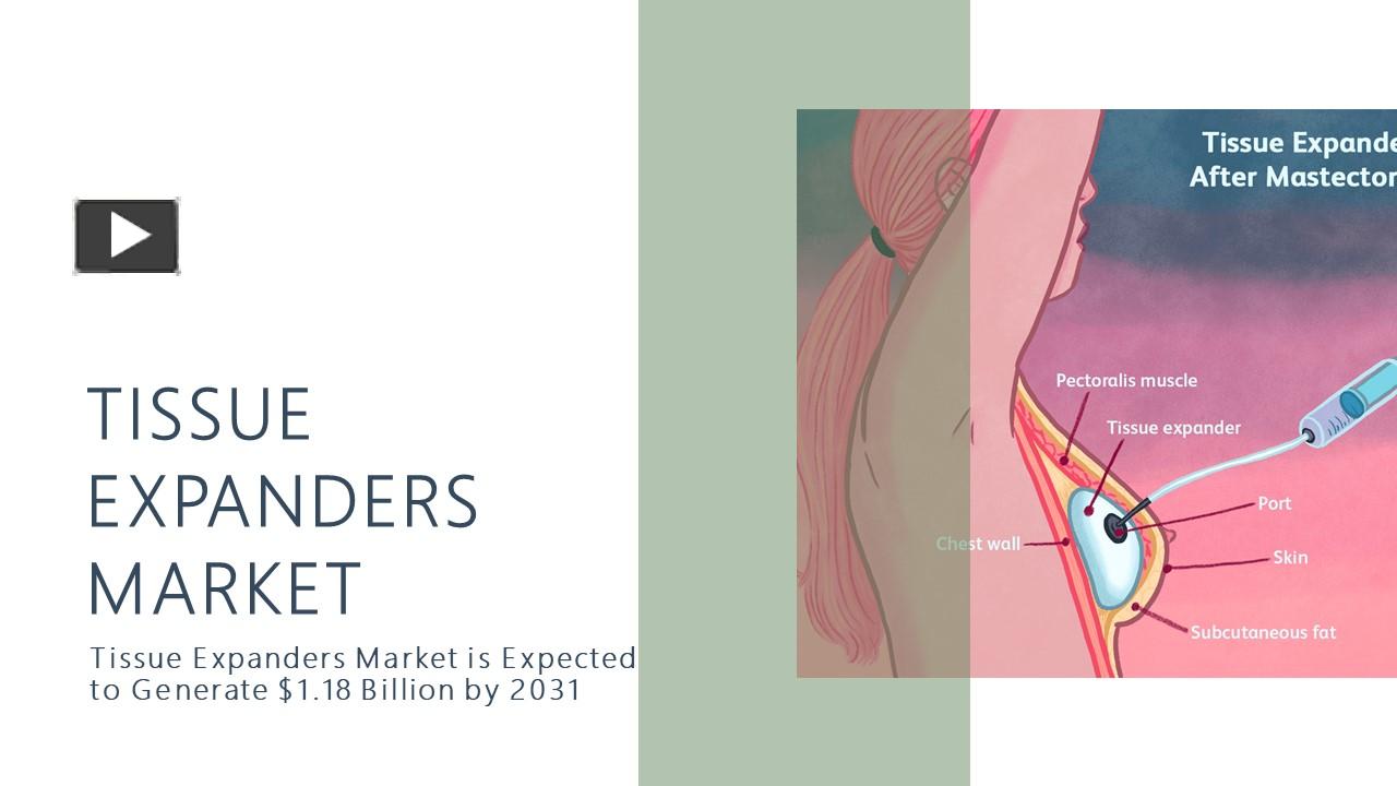 PPT – Tissue Expanders Market PowerPoint presentation | free to ...