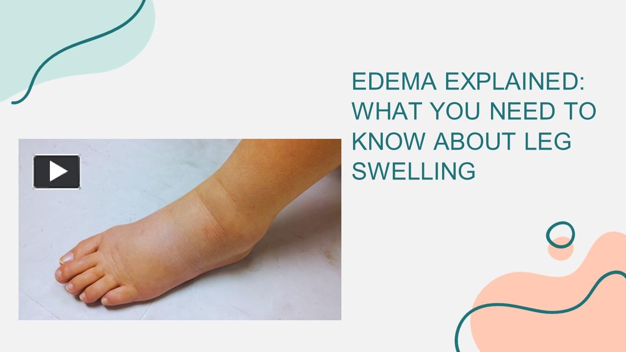 Leg Edema Treatment in Coimbatore | Leg Swelling Doctor in Coimbatore ...