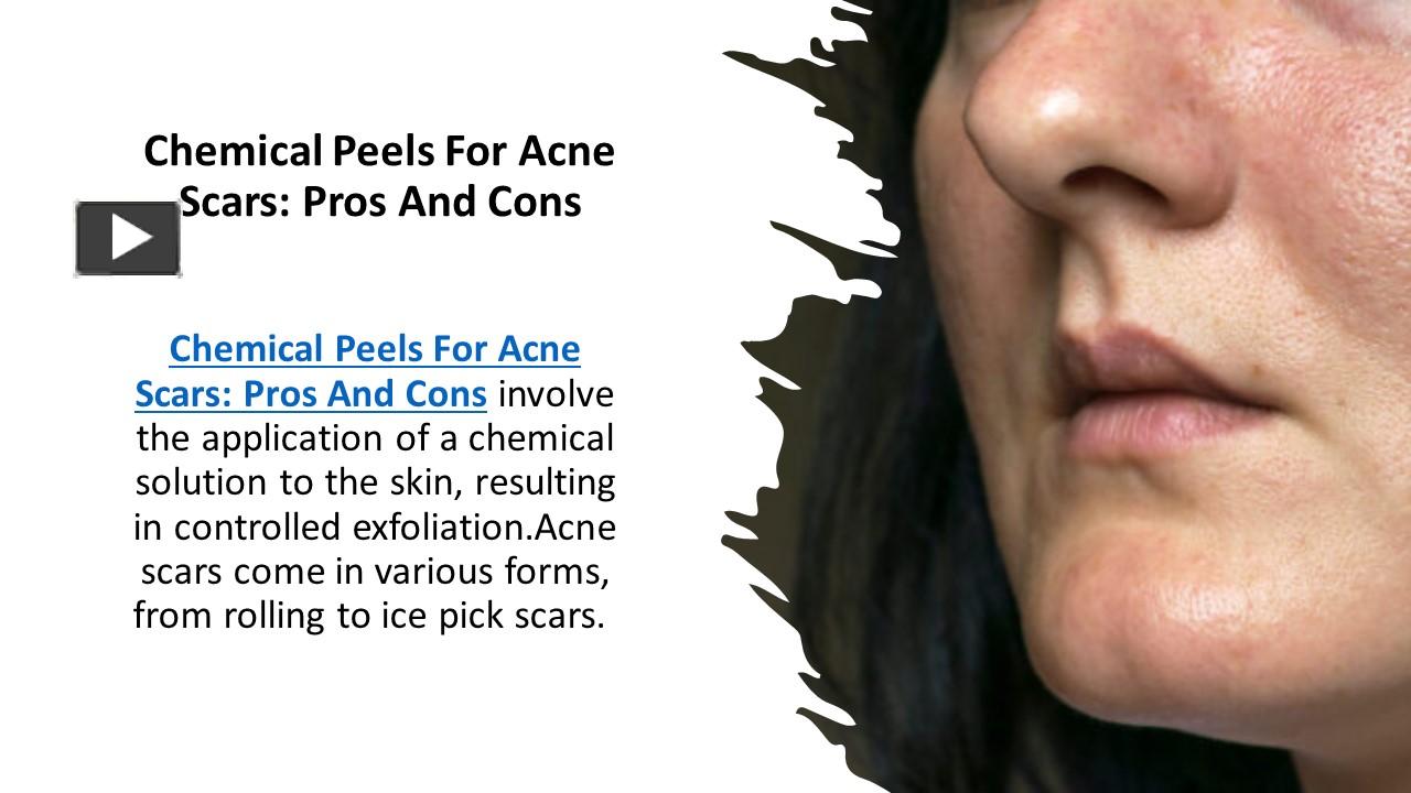 Chemical Peels For Acne Scars: Pros And Cons presentation | free to ...