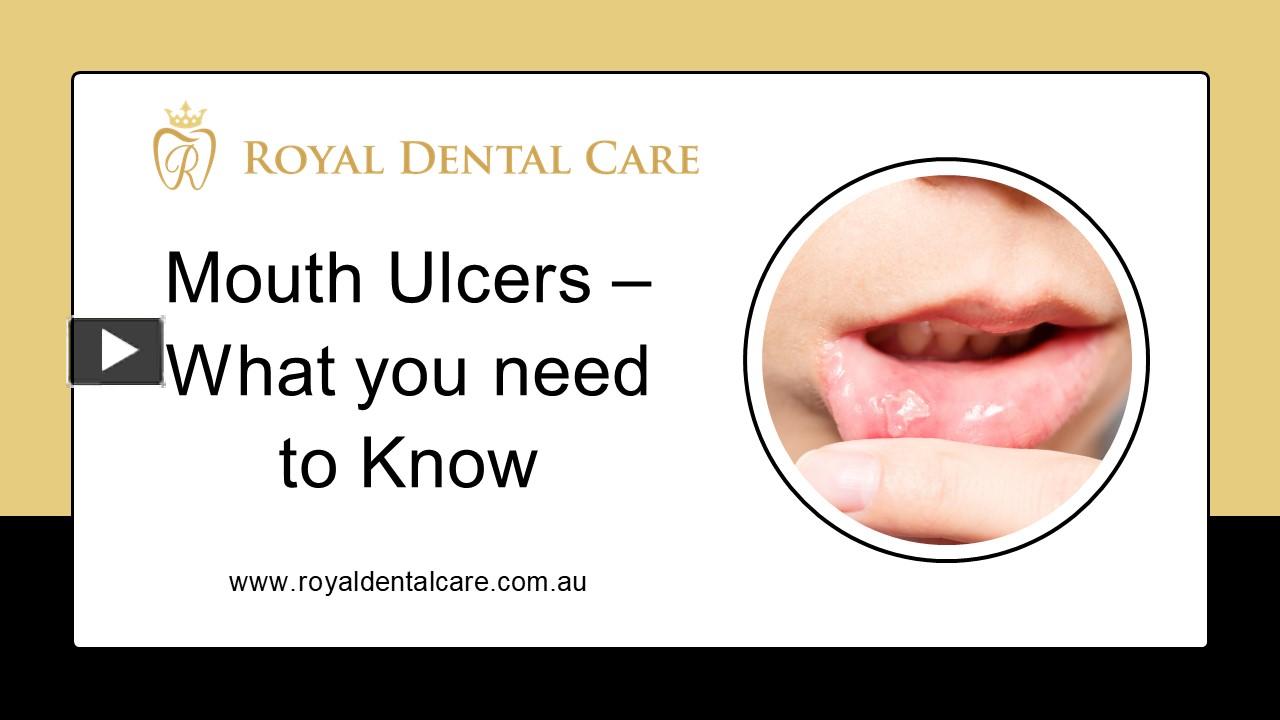 Mouth Ulcers – What you need to know presentation | free to download
