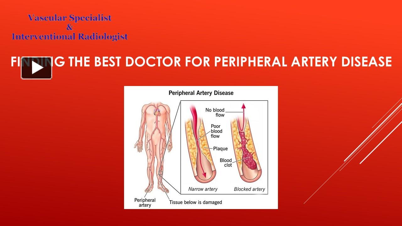 PPT – Finding the Best Doctor for Peripheral Artery Disease PowerPoint ...