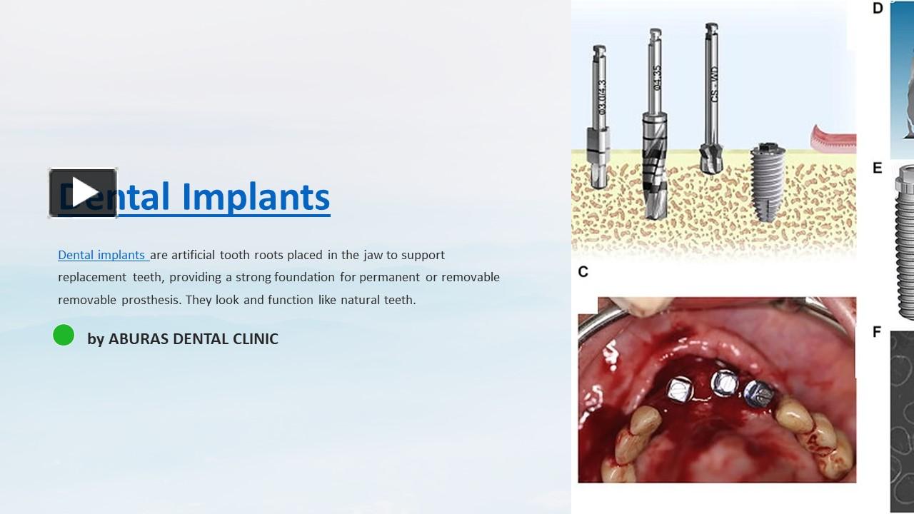 Dental Implants Presentation Free To Download