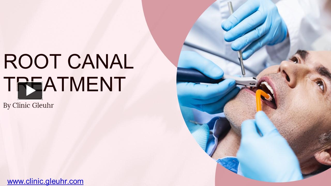 PPT – What is Rool Canal Treatment? PowerPoint presentation | free to ...