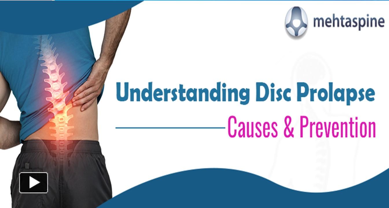 Understanding Disc Prolapse: Causes, Complications ; Prevention ...