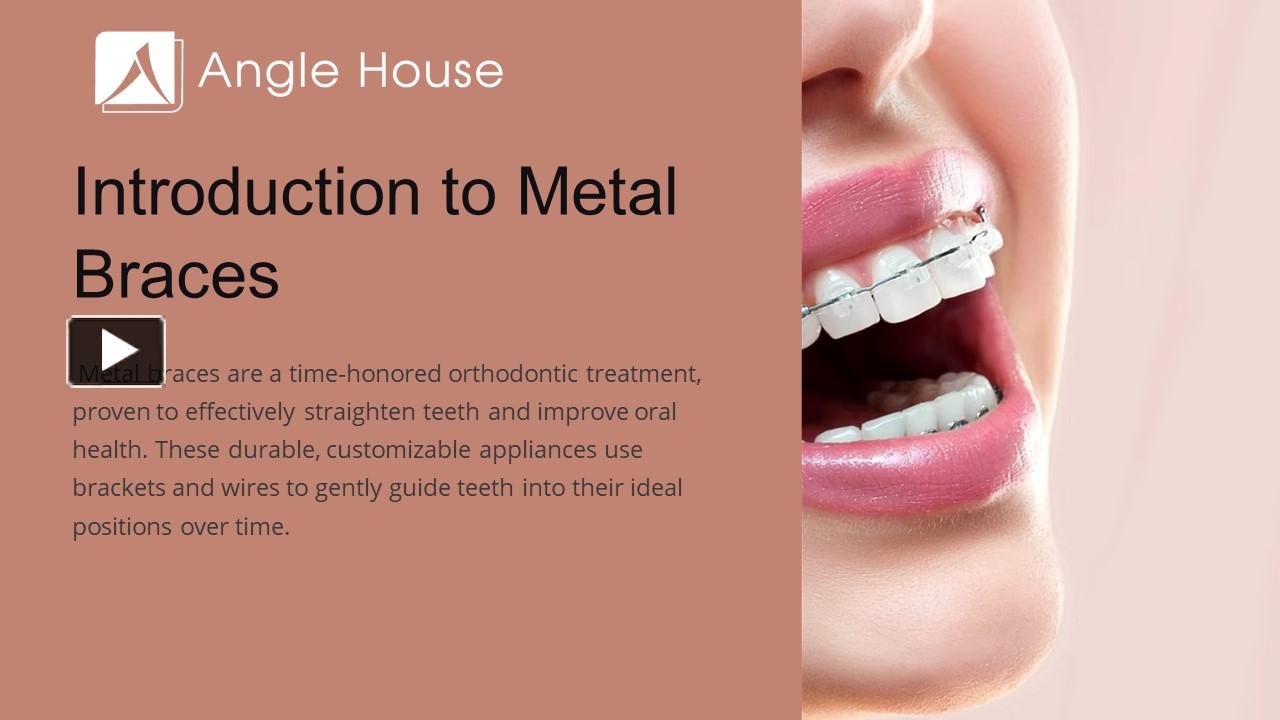 PPT – Introduction to Metal Braces PowerPoint presentation | free to ...
