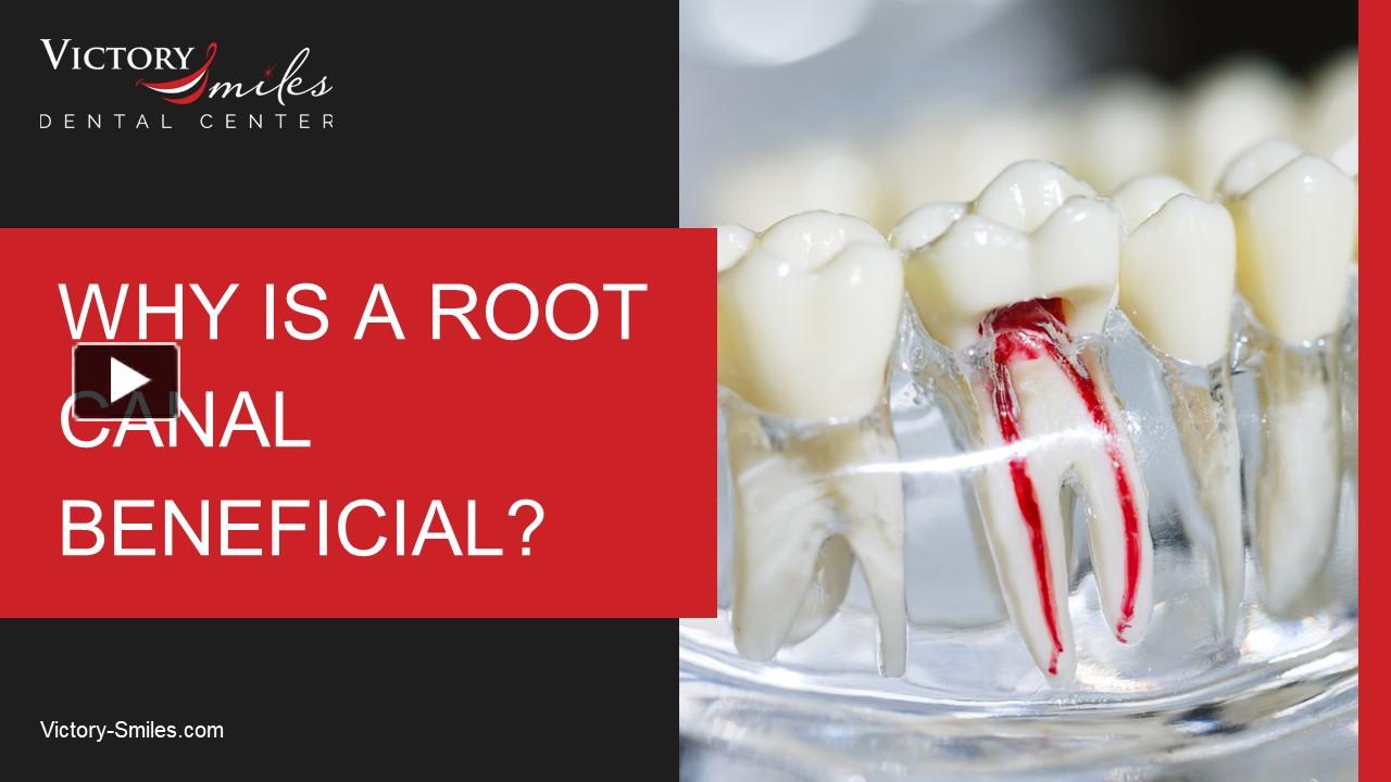 Why is a Root Canal Beneficial presentation | free to view