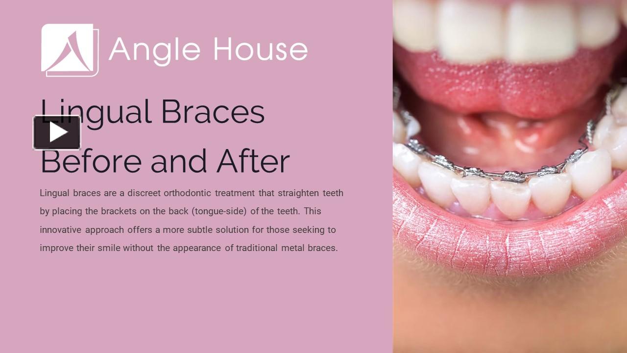 Lingual Braces Before and After presentation | free to download