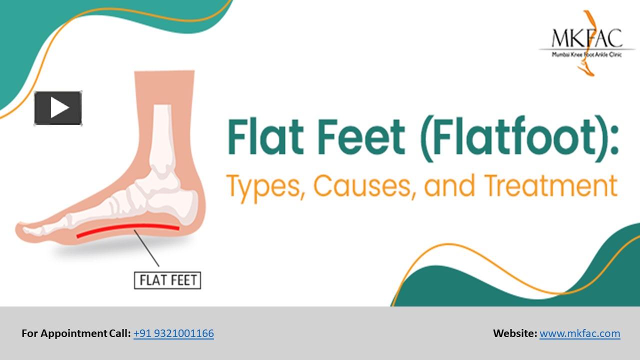 Flat Feet (Flatfoot) Types Causes and Treatment | MKFAC presentation ...