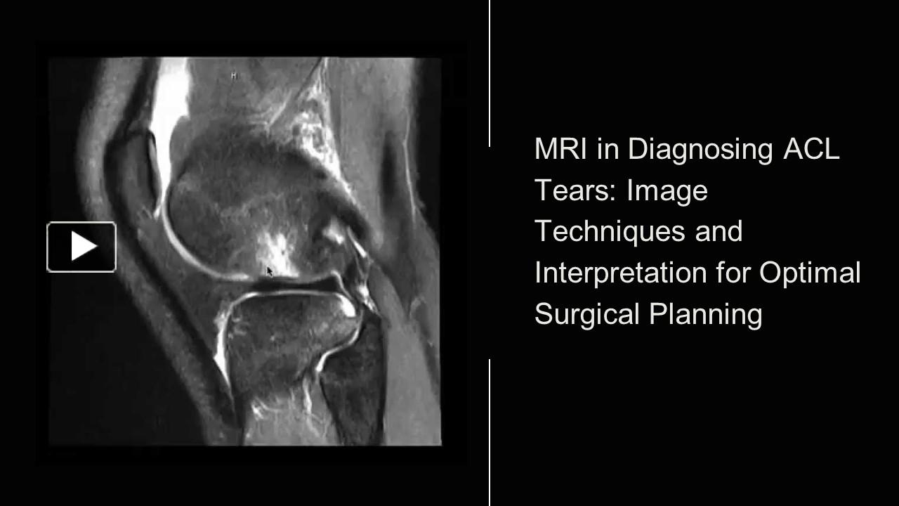 Pristyn Care: MRI in Diagnosing ACL Tears: Image Techniques and ...