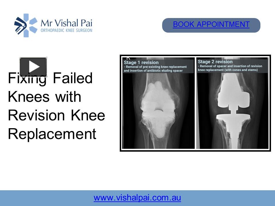 PPT – Fixing Failed Knees with Revision Knee Replacement PowerPoint ...
