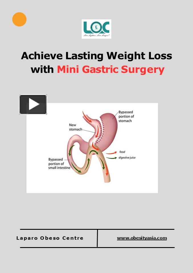 PPT – Achieve Lasting Weight Loss with Mini Gastric Surgery PowerPoint ...