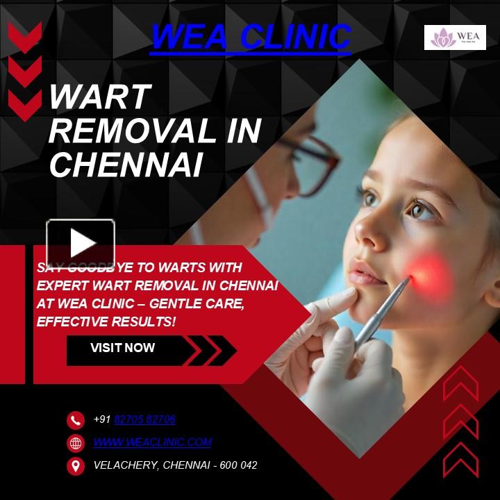 PPT – Say Goodbye to Warts with Effective Wart Removal in Chennai at ...