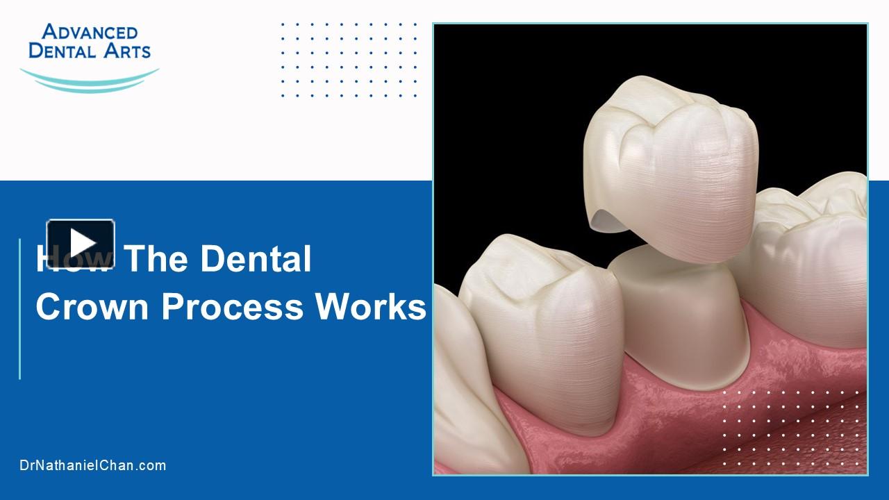 Understanding the Dental Crown Process presentation | free to download