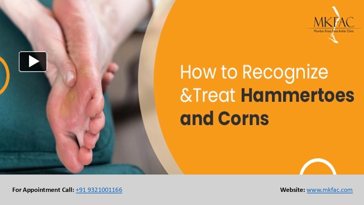 PPT – How to Recognize and Treat Hammertoes and Corns | MKFAC ...