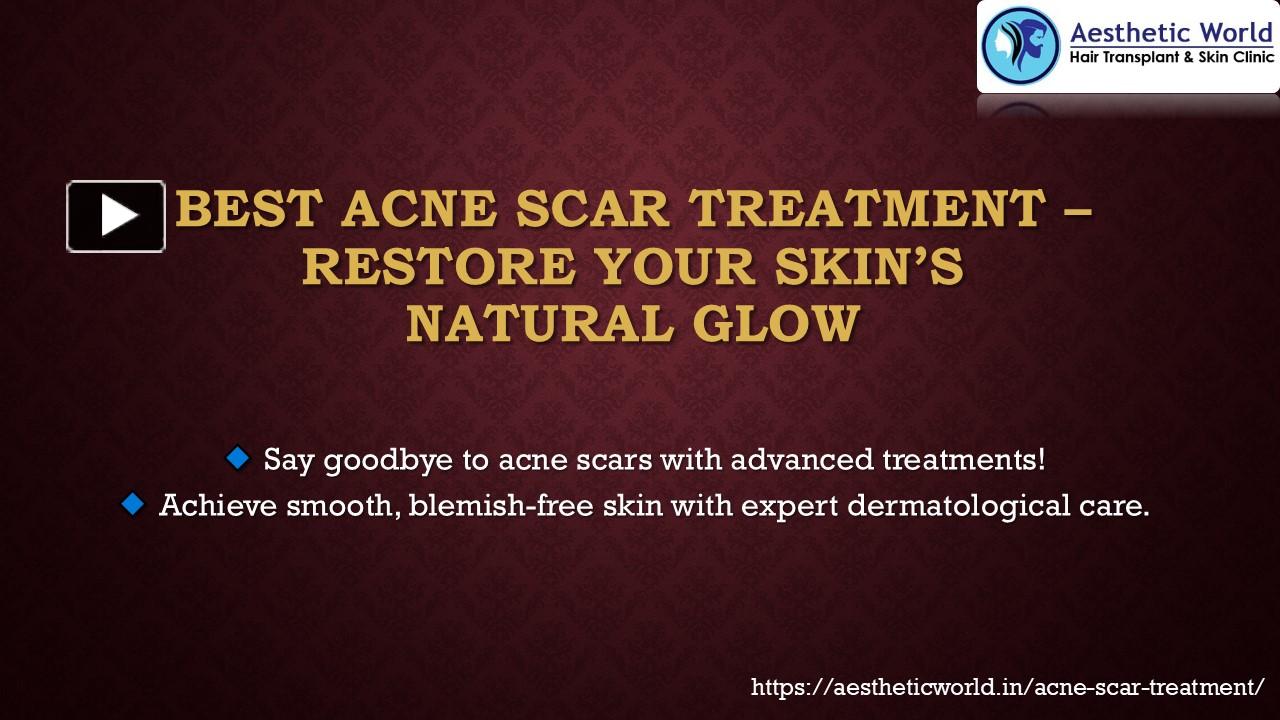 PPT – Erase Acne Scars: The Ultimate Guide to Flawless Skin PowerPoint ...