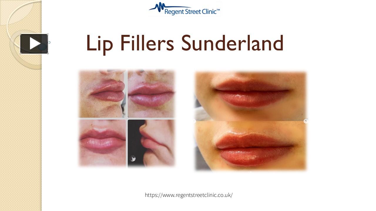 PPT – Lip Fillers Sunderland PowerPoint presentation | free to download ...