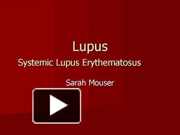 Lupus Systemic Lupus Erythematosus presentation | free to view