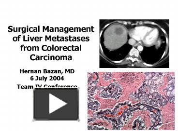 Surgical Management of Liver Metastases from Colorectal Carcinoma ...