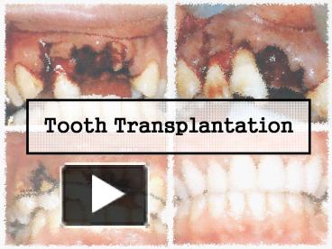 Tooth Transplantation presentation | free to view