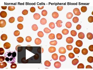 Normal Red Blood Cells Peripheral Blood Smear presentation | free to view