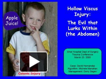 PPT – Hollow Viscus Injury: PowerPoint presentation | free to view - id ...
