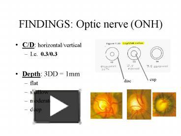 FINDINGS: Optic nerve ONH presentation | free to view
