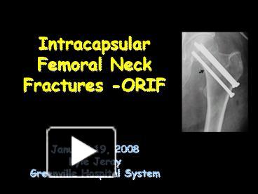 Intracapsular Femoral Neck Fractures ORIF presentation | free to view