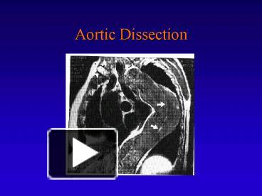 Aortic Dissection presentation | free to view