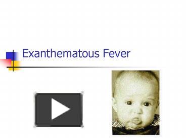 Exanthematous Fever presentation | free to view