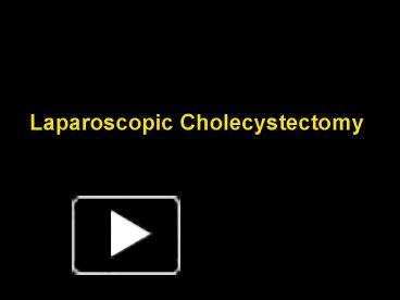 Laparoscopic Cholecystectomy presentation | free to view