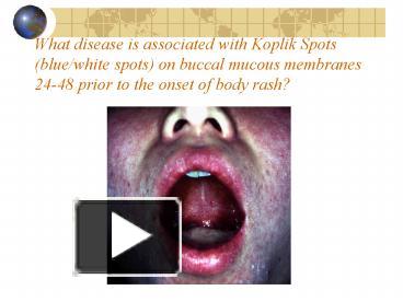What disease is associated with Koplik Spots bluewhite spots on buccal ...