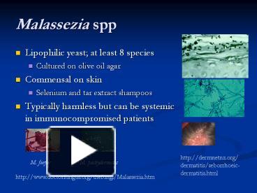 Malassezia spp presentation | free to download